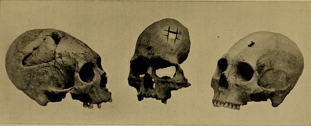 Wow! Deformed “alien” skulls have been unearthed in Hungary ...